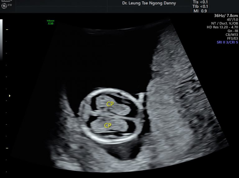 First Trimester Fetal Morphology Scan - HKOG-INFO