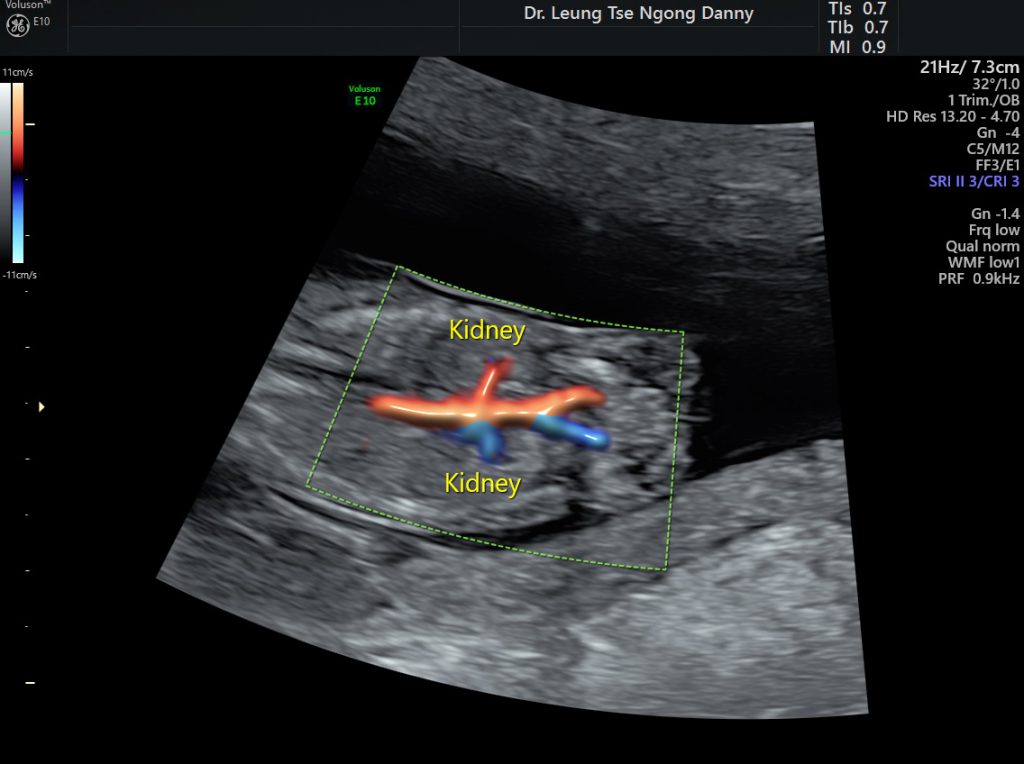 First Trimester Fetal Morphology Scan - HKOG-INFO