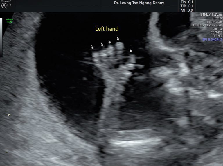 First Trimester Fetal Morphology Scan - HKOG-INFO