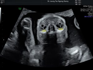 Routine fetal morphology scan - HKOG-INFO