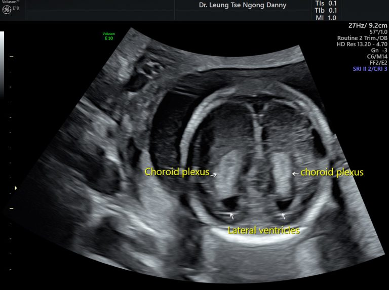 Routine fetal morphology scan - HKOG-INFO