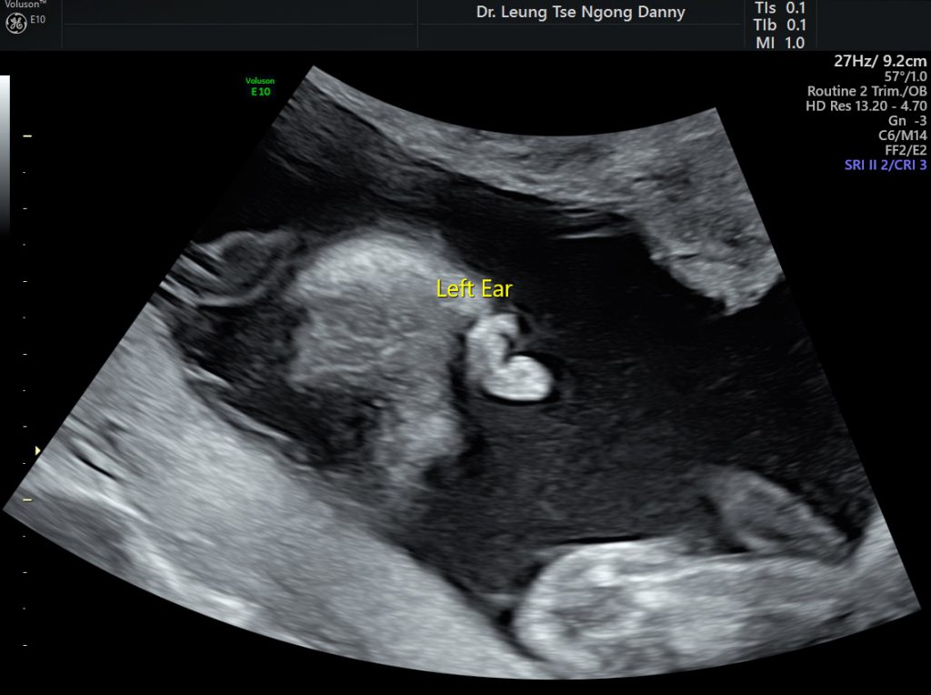 Routine fetal morphology scan - HKOG-INFO