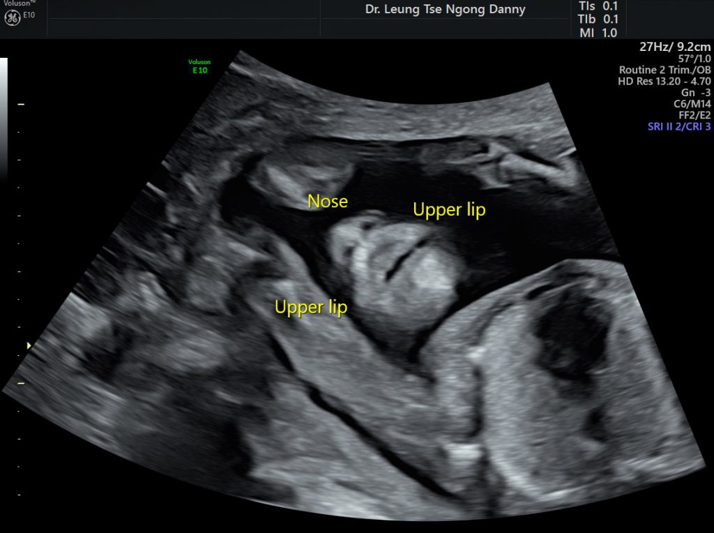 Routine fetal morphology scan - HKOG-INFO