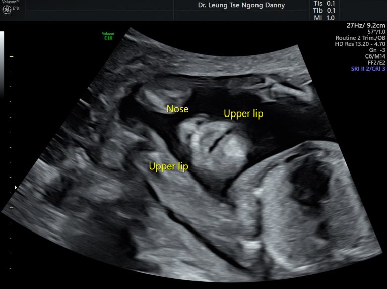 Routine fetal morphology scan - HKOG-INFO