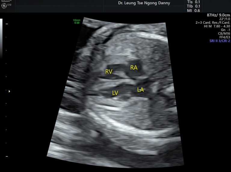 Routine fetal morphology scan - HKOG-INFO