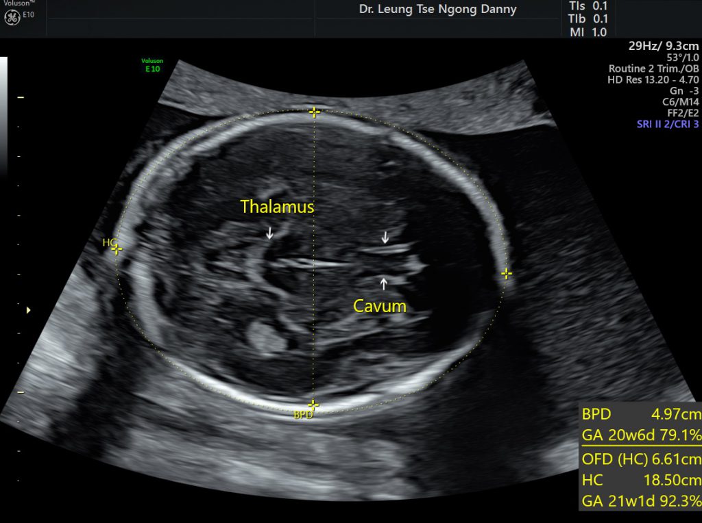 Routine fetal morphology scan - HKOG-INFO