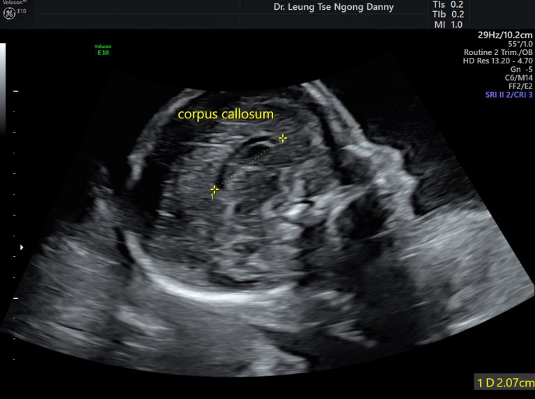 Routine fetal morphology scan - HKOG-INFO