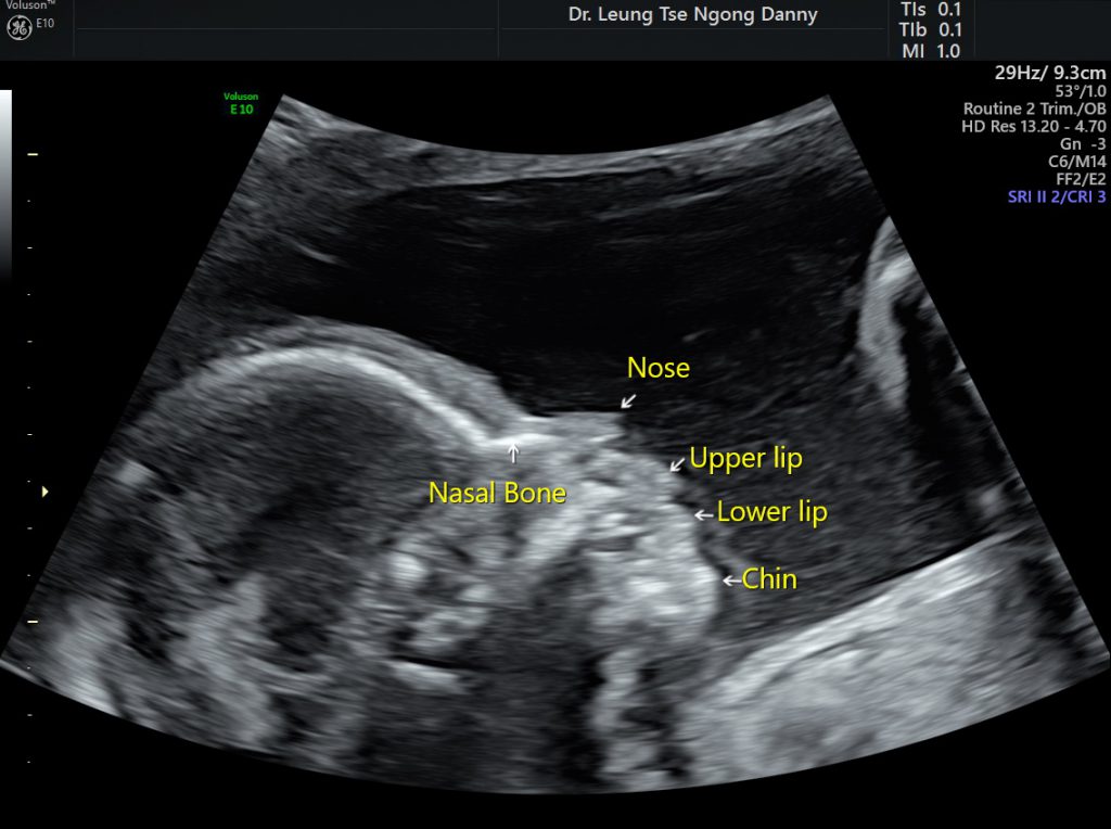 Routine fetal morphology scan - HKOG-INFO