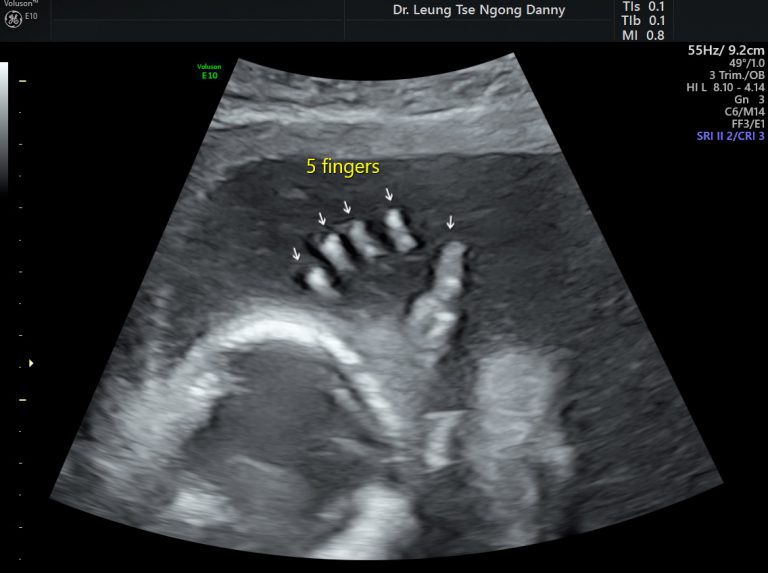 Routine fetal morphology scan - HKOG-INFO