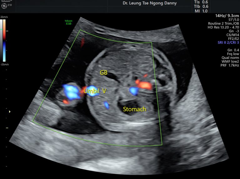 Routine fetal morphology scan - HKOG-INFO