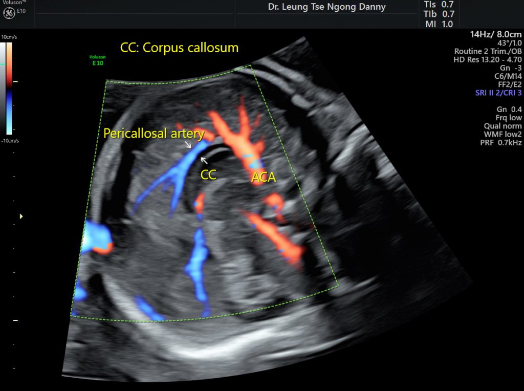 Routine fetal morphology scan - HKOG-INFO