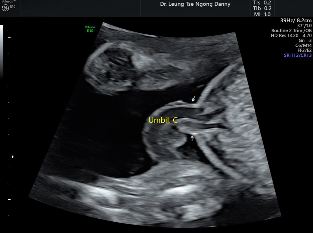 Routine fetal morphology scan - HKOG-INFO