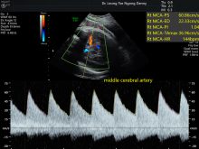 Doppler ultrasound - HKOG-INFO