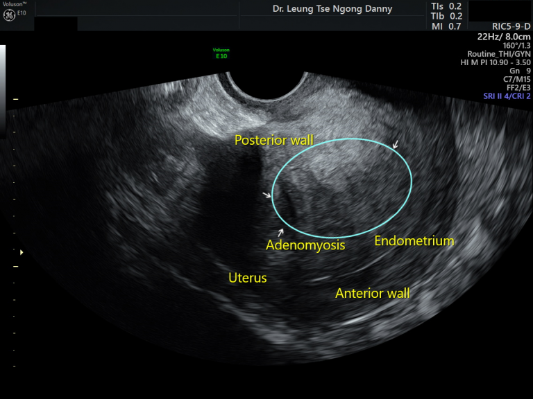 Adenomyosis - HKOG-INFO